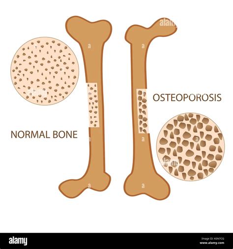 Osteoporosis Bone Anatomy Versus Normal Health Bone Vector Format Illustration Stock Vector