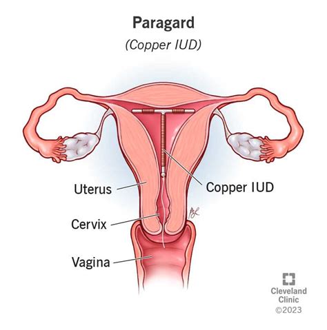 Paragard Iud Weight Gain
