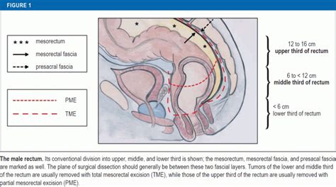 Total Mesorectal Excision