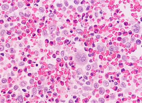 Langerhans Cells Histology Rare Case Of Langerhans Cell Histiocytosis