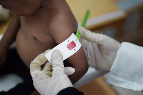 Ipc Acute Malnutrition Analysis Unicef Yemen