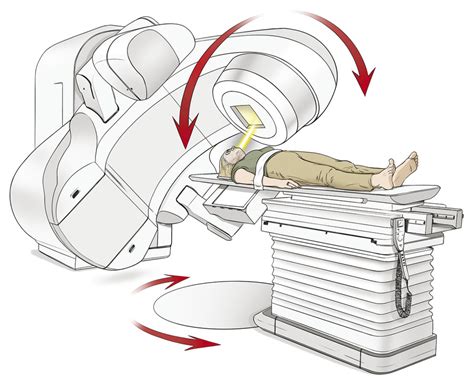 Linac Radiosurgery At Sebastian Williams Blog