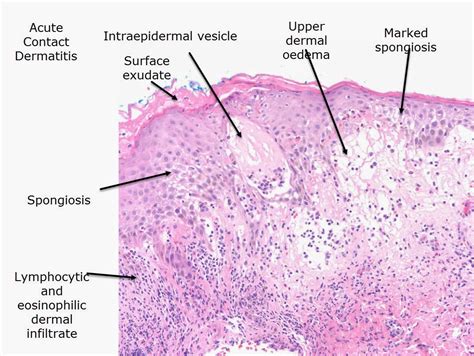 Allergic Eczema Pictures Pictures Photos