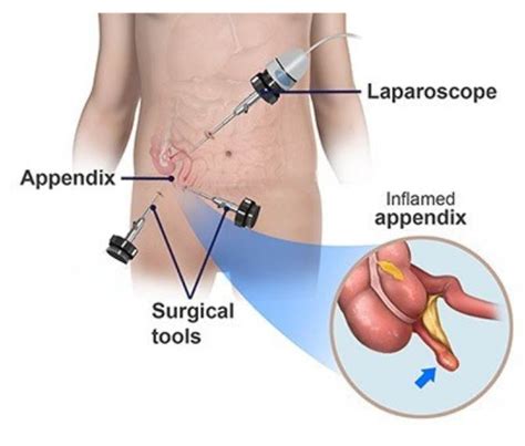 Appendix Treatment Surgery In Sarjapur Road Hsr Layout