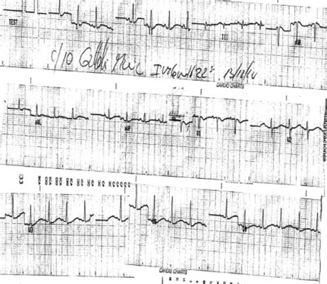 Corrected QT Interval On Admittance 0 66 Seconds Download Scientific Diagram