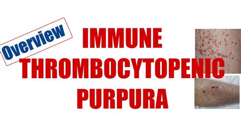 Idiopathic Thrombocytopenic Purpura Itp Overview Symptoms Diagnosis Treatment Easy Med