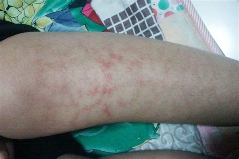 下肢毛细血管扩张红血丝图片