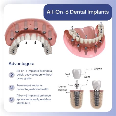 All On 6 Dental Implants