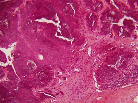 Histologic Exam Showing Foreign Body Giant Cell Reaction Download