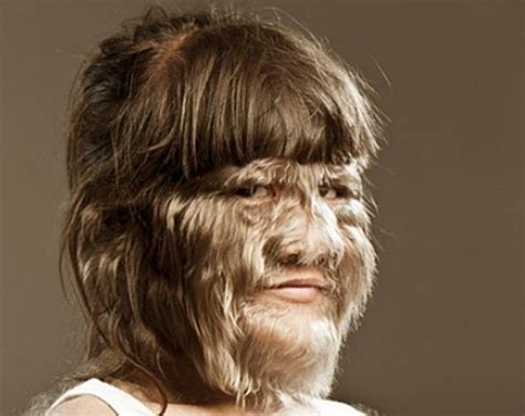 👉 Hypertrichosis Symptoms Causes Treatment Pictures December 2021