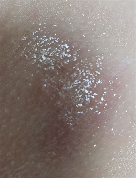 6세 여아 엉덩이 발진 지식in