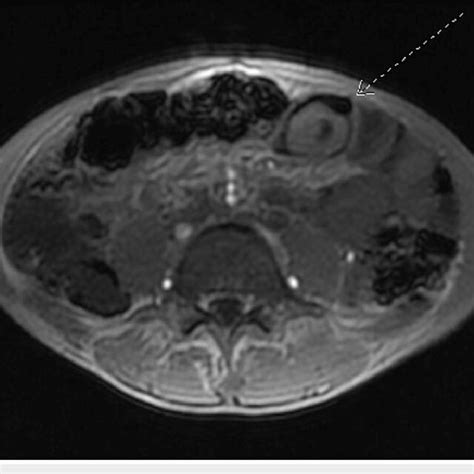 At Least Two Areas Of Small Bowel Small Bowel Intussusception Were Download Scientific Diagram