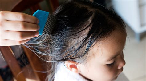 Nits In Hair