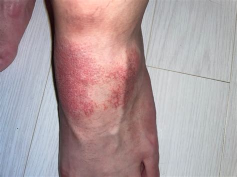 발 습진 빨간색 지식in