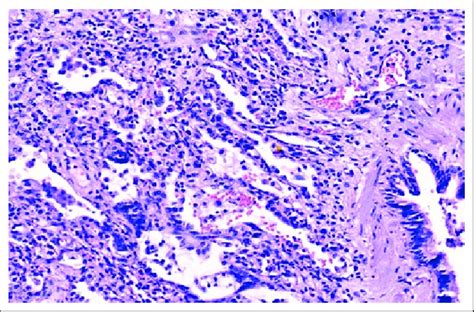 Nonfibrotic Hp Surgical Lung Biopsy 20x Shows Cellular Interstitial