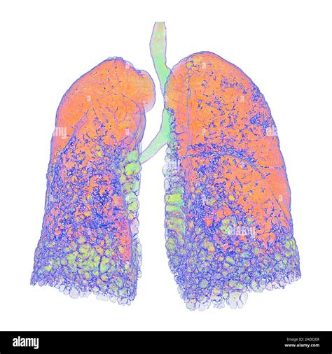 Usual Interstitial Pneumonia Coloured 3d Computed Tomography Ct Scan Of The Lungs Of A