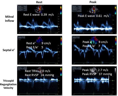 Diastolic Stress Echocardiography From Basic Principles To Clinical