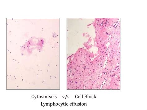 Cell Block In Cytology Ppt