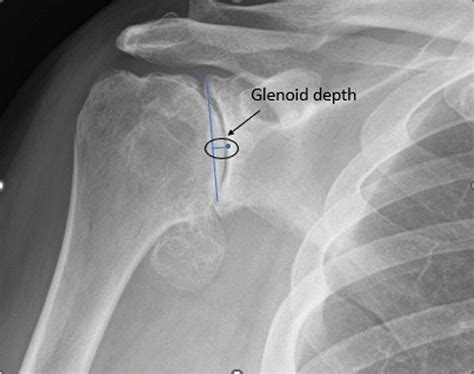 Glenoid Depth Was Measured As The Distance Between The Center Of The