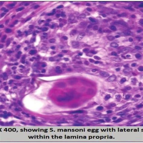 Photomicrograph Of The Resected Appendix Download Scientific Diagram