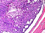 Intraductal Papilloma Of The Breast Libre Pathology