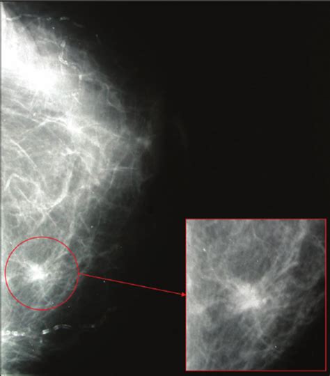 Mammography Showed An Ill Defined High Density Spiculated Mass Download Scientific Diagram