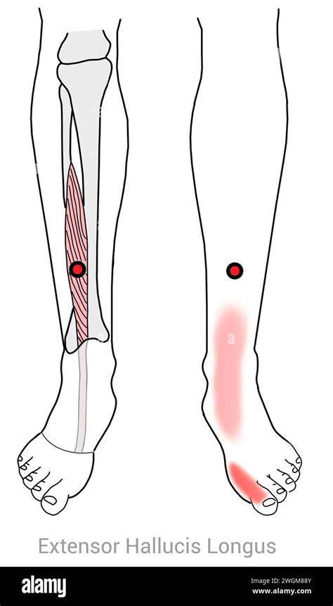Lower Extremity Extensor Strength At Janita Huang Blog