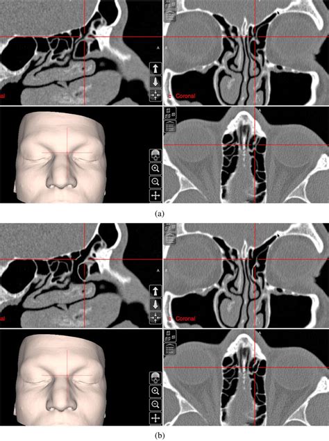 A B Ct Scan Of Frontal Recess Illustrating Grade 0 Extent Of Download Scientific Diagram