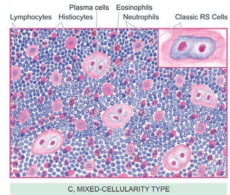 Mixed Cellularity Type Hodgekins Lymphoma Medizzy