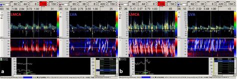 The Spectra On Contrast Enhanced Transcranial Doppler C Tcd Of Download Scientific Diagram
