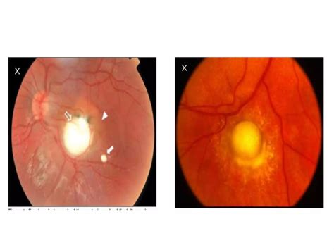 Post Uveitis Seminarpptx