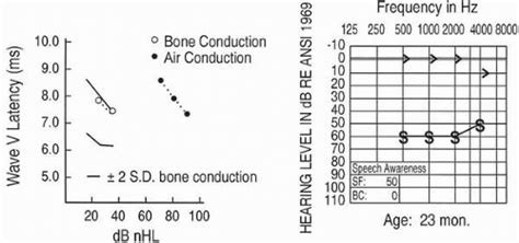 Audiologic Tests For Otologic Surgery Ento Key