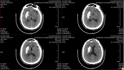 右侧基底节区脑出血微创钻孔！ 脑医汇 神外资讯 神介资讯
