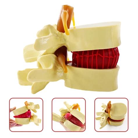 Spine Model Human Lumbar Herniation Intervertebral Disc Body £2040