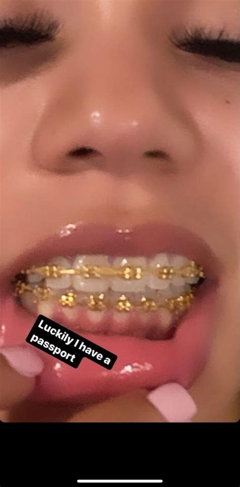 Gold Braces Braces Colors Cute Braces Cute Braces Colors