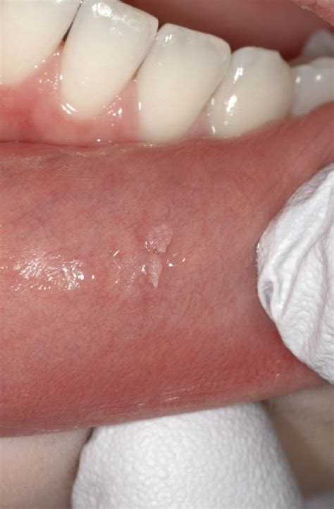 Tumores Benignos De La Mucosa Oral Quintessence