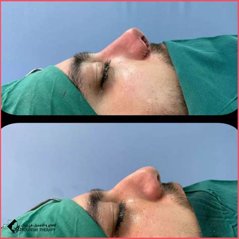 المواصفات والسعر وحجز موعد تجميل الأنف الدكتور جواد اسلامي