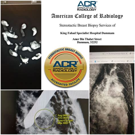 Just Received The Acr Accreditation For Stereotactic Breast Biopsy