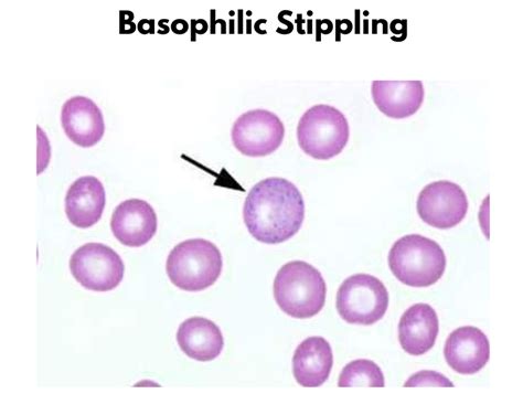 Red Cell Inclusions • The Blood Project