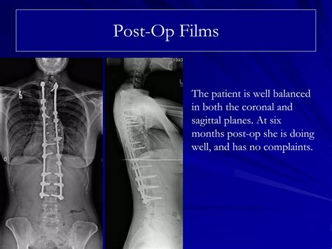 Case Review 38 22 Year Old Female Status Post Spinal Fusion With Pseudoarthrosis Ppt