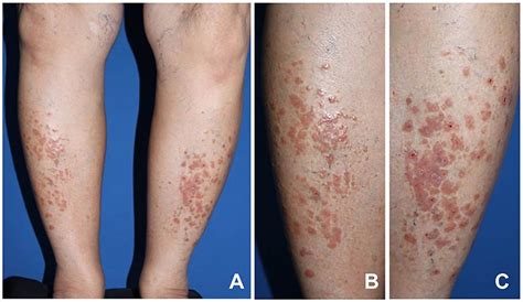 Pppd Treatment With Pentoxifylline Ccid