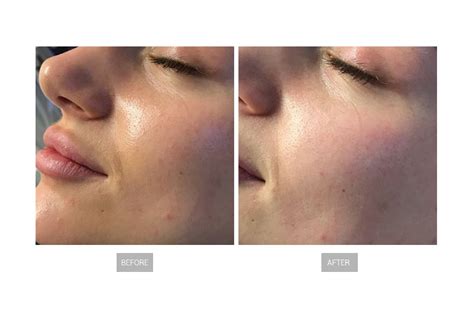 14 In 1 Hydra Dermabrasion Skincare Machine With Oxygen Mask Konmison