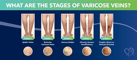 Severe Varicose Veins Description