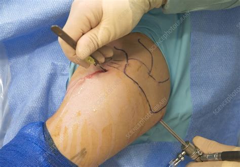 Dislocated Shoulder Surgery Stock Image C001 4632 Science Photo Library