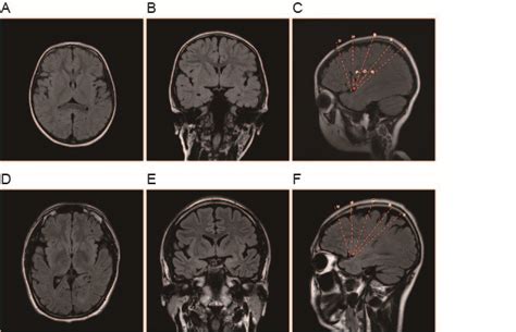 Stereotactic Eeg Guided Multiple Electrode Stereo Conformal