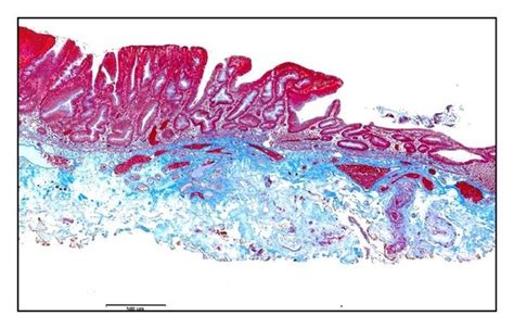Sections Of Laterally Spreading Tumor Nongranular Lst Ng Type With Download Scientific Sections Of Laterally Spreading Tumor Nongranular Lst Ng Type With Download Scientific