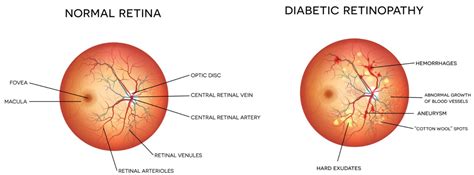 논문 리뷰 Robust Multi Disease Retinal Classification Via Xception Based