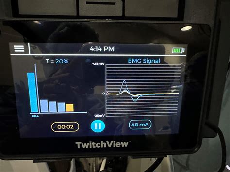 How To Monitor Succinylcholine Induced Neuromuscular Blockade