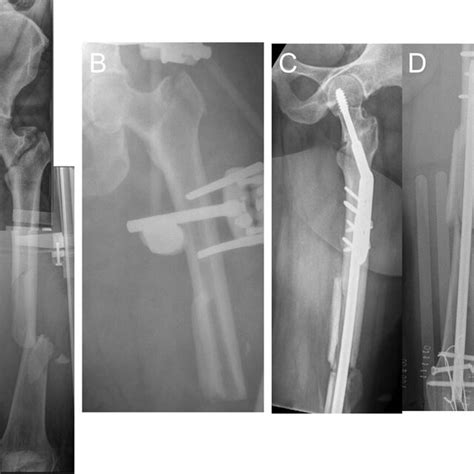 Case Example 2 A 40 Year Old Male With An Open Right Segmental Download Scientific Diagram