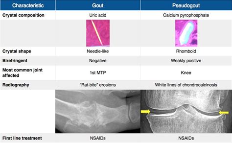 Rosh Review Gout Nsaids Gout Treatment Rosh Review Gout Nsaids Gout Treatment